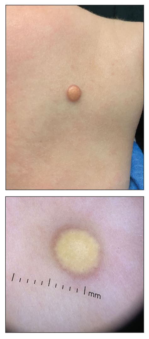 Solitary Yellow Papule On The Upper Back In An Infant Mdedge