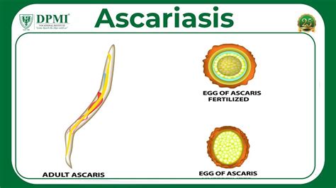 Ascariasis Causes Symptoms Signs Diagnosis Treatment How To Recognize