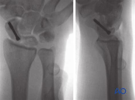 Orif Through Dorsal Approach Antegrade Screw Fixation For Scaphoid Waist Fracture