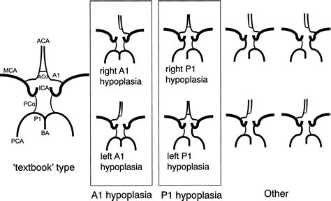 Relationship Between Variations In The Circle Of Willis And Flow Rates In Internal Carotid And