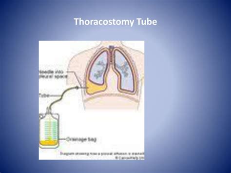 Ppt Hemopneumothorax Powerpoint Presentation Free Download Id2377648