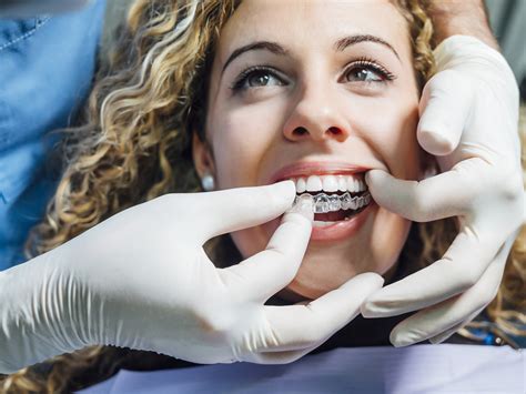 Does Invisalign Give You Perfect Teeth Invisalign Aligners