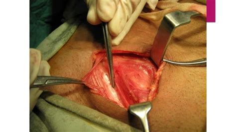 Hernia Operation Ppt