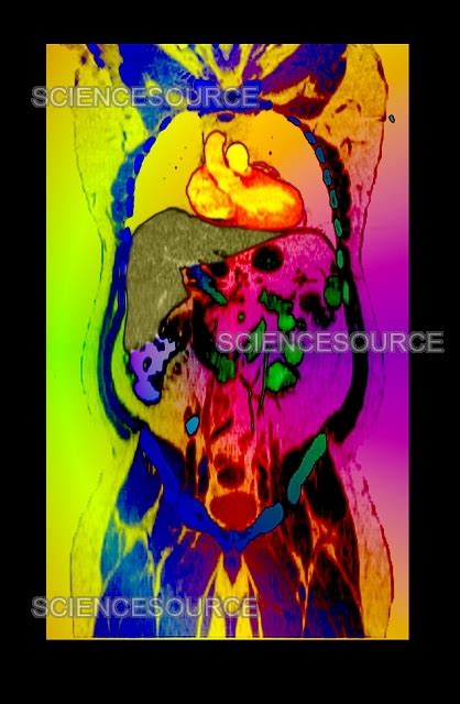 Spiral Ct Reconstruction Stock Image Science Source Images