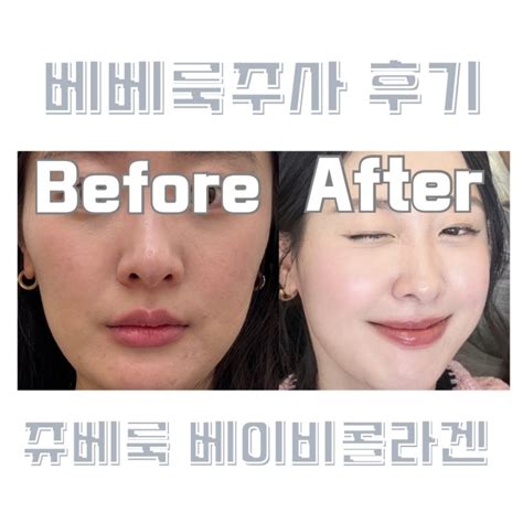 강남피부과 쥬베룩 후기 쥬베룩볼륨후기 쥬베룩스킨부스터효과 쥬베룩효과 쥬베룩효과나타나는시기 네이버 블로그