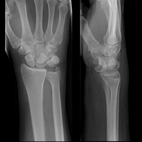 Perilunate Dislocation Radiology Reference Article Radiopaedia Org Dislocation Radiology