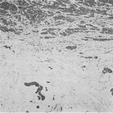 Granular Cell Myoblastoma Suprasternal Fossa Case 7 Small Groups Of