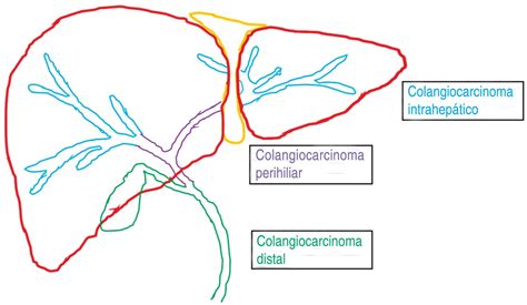 Tipo De Colangiocarcinoma