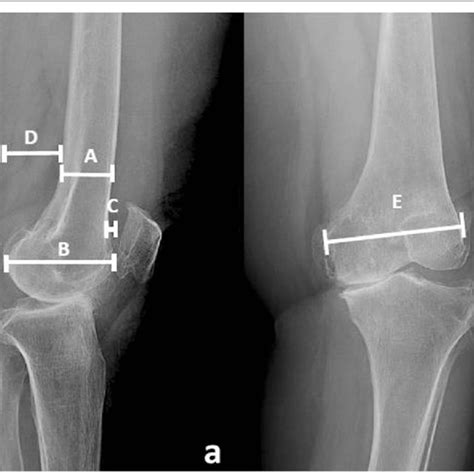 Pdf Risk Factors And Outcomes In Asymmetrical Femoral Component Size For Posterior Referencing