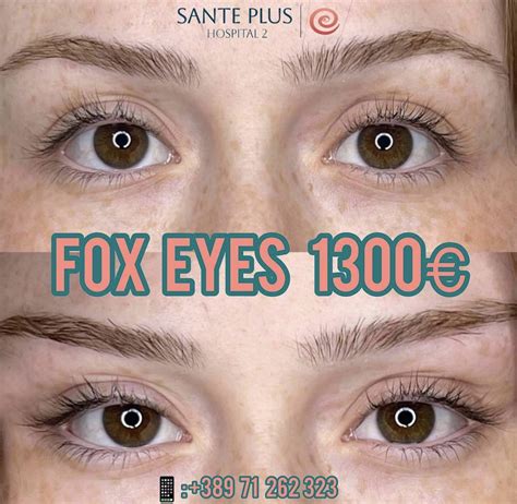 ‼️ Fox Eyes 1300€ Tërheqja E Syve Sante Plus Hospital2