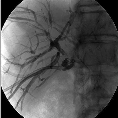 Percutaneous Transhepatic Biliary Drainage Cholangiogram Revealed Download Scientific Diagram