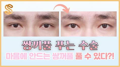 쌍꺼풀 제거수술 맘에 안드는 쌍꺼풀 자연스럽게 풀 수 있다 쌍꺼풀 없애는 수술 설명도 듣고 전후사진도 많이 보자 Youtube