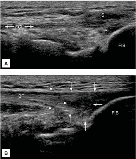 Distal Biceps Femoris Injection Wikism Sports Medicine Wiki