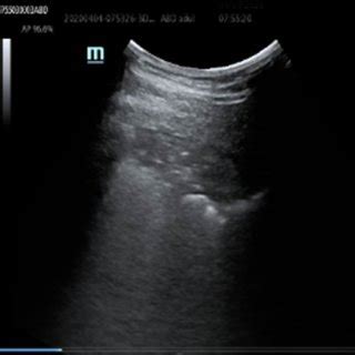 Convex Array Probe Showed Consolidation With Dynamic Air Bronchogram In Download Scientific