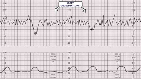 How To Read A Ctg Ctg Interpretation Geeky Medics