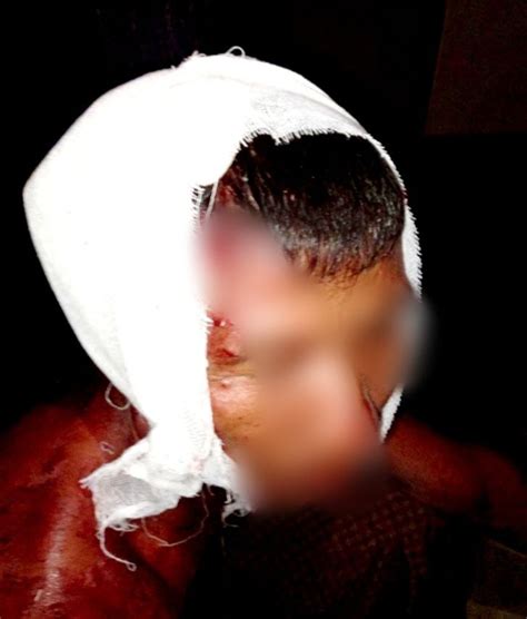 မြေပုံ၊ စညှင်းရွာကို စစ်ကောင်စီက ဂျက်ဖိုက်တာနန့် ဗုံးကြဲ၊ အပြစ်မဲ့ပြည်သူ ၃ ယောက် ပြင်းထန်ဒဏ်ရာရ