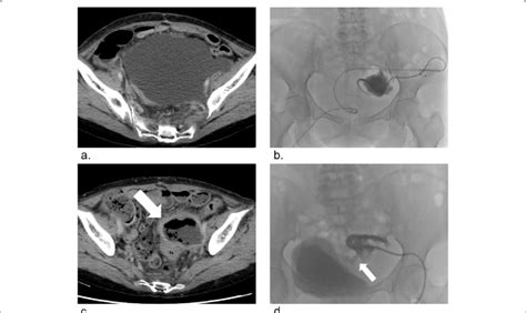 A Contrast Enhanced Computed Tomography Ct After Gynecological Cancer Download Scientific