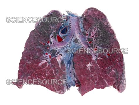 Lung Silicosis Stock Image Science Source Images