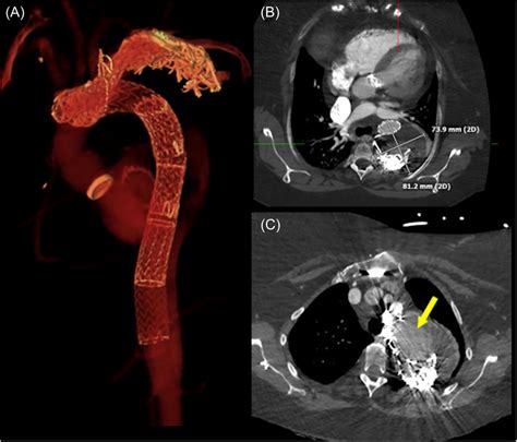 Preoperative Cta 3d Reconstruction A Demonstrating Previous