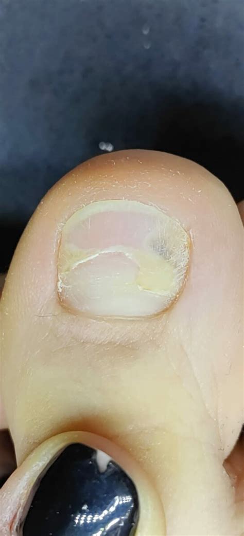 Macchie Unghie Piedi Forum Dermaclub