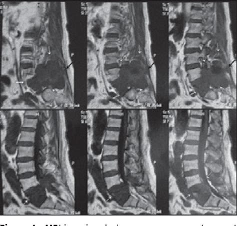 Figure 1 From Paravertebral Abscess By Escherichia Coli And Melanoma