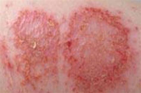 Discoid Eczema