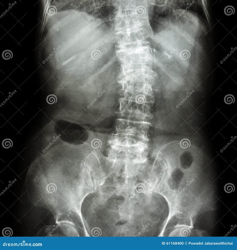 Spondylosis And Scoliosis Film X Ray Lumbar Sacrum Spine Show Crooked Spine Old Patient
