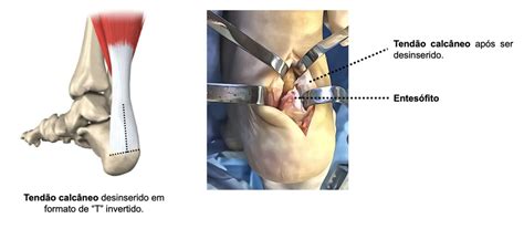 Tendinopatia Insercional Do Tendão Calcâneo Dr Danilo Ryuko