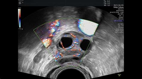 Voluson™ S8 Touch Ultrasound System Ge Healthcare