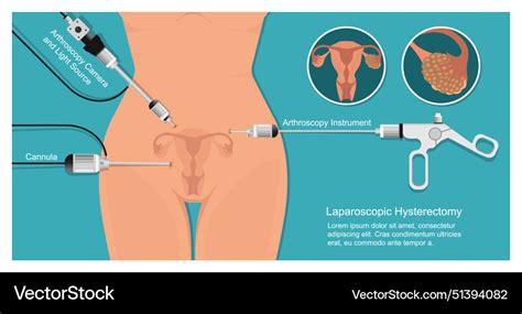 Laparoscopic Surgery For Treatment Fibroids Vector Image