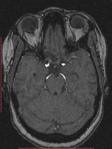 A1 Segment Hypoplasia Image