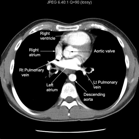 Heart Ct Scan Labeled