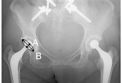 Radiological Method Of Measuring Acetabular Component Radiographic Download Scientific Diagram