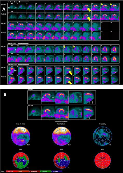PET Myocardial Perfusion Imaging A MPI Shows Large Myocardial Download Scientific Diagram