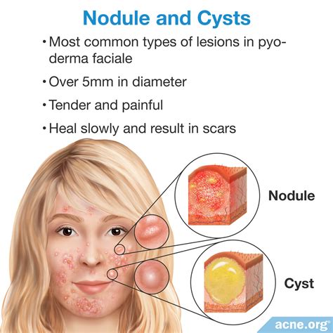 What Is Pyoderma Faciale