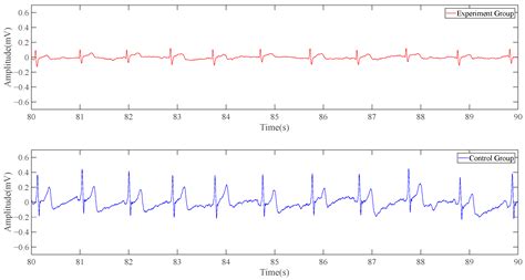 Sensors Free Full Text Single Position Ecg Detection System Based On Charge Induction