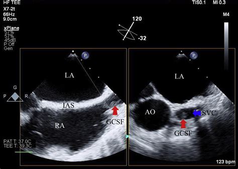 Bicaval View Of Tee Delineating The Entire Gcfs Red Arrow From Download Scientific Diagram