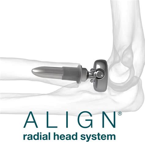 Skeletal Dynamics On Linkedin Align® Radial Head System A Monoblock
