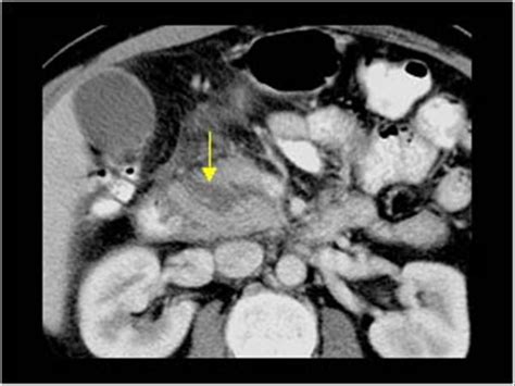 Abdomen And Retroperitoneum 1 3 Pancreas Case 1 3 5 Acute