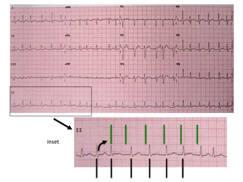Atrial Flutter Sawtooth Ecg