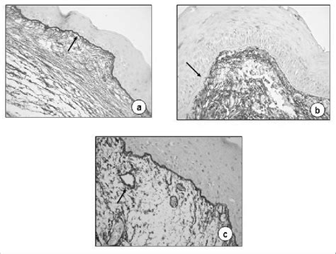 Reinkes Edema Fibronectin Immunoexpression On The Basal Membrane A Download Scientific
