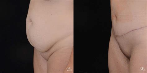 Monsplasty Fupa Reduction Gallery