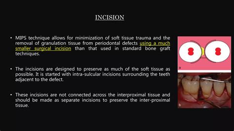 Minimally Invasive Periodontal Surgery Pptx