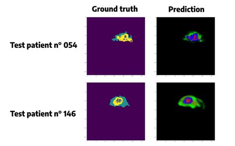 image segmentation train a u net model to segment brain tumors