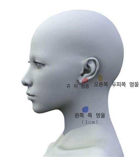 귀 뒤 목 옆 멍울 사진 첨부 지식in