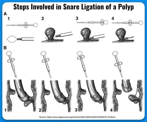 🔍 Essential Guide Advanced Polypectomy Techniques Key Steps For