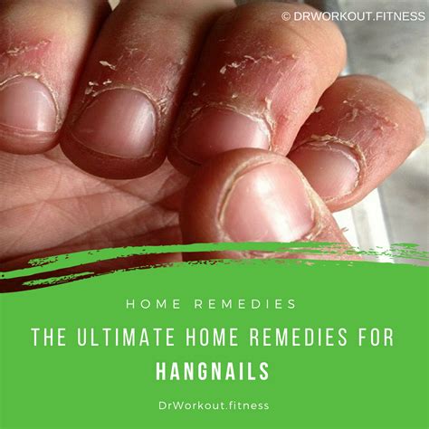 How To Get Rid Of Hangnails 10 Steps With Pictures Artofit