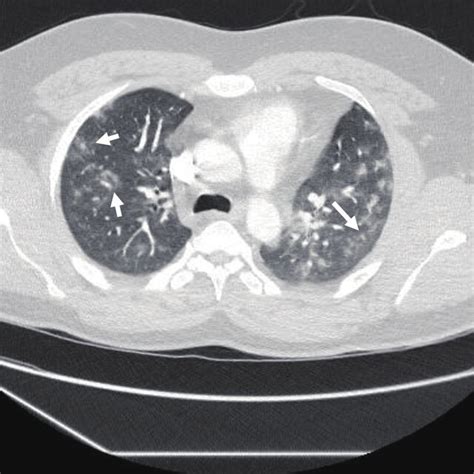 Computed Tomography Pulmonary Angiography Showing No Pulmonary Embolism Download Scientific