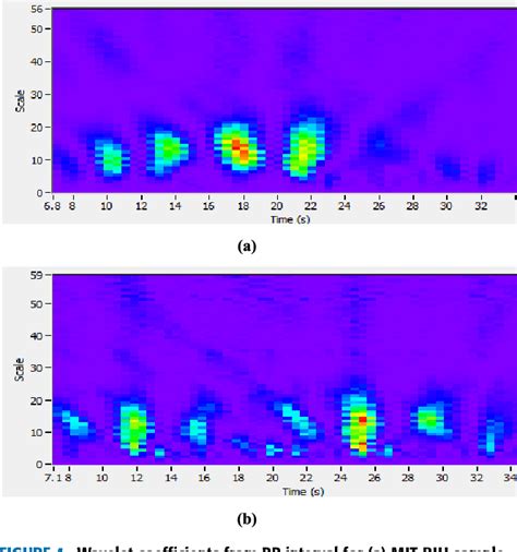 Figure 2 From Ecg Signal Preprocessing And Svm Classifier Based