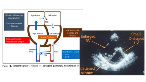 Seminar On PPHN PPTX